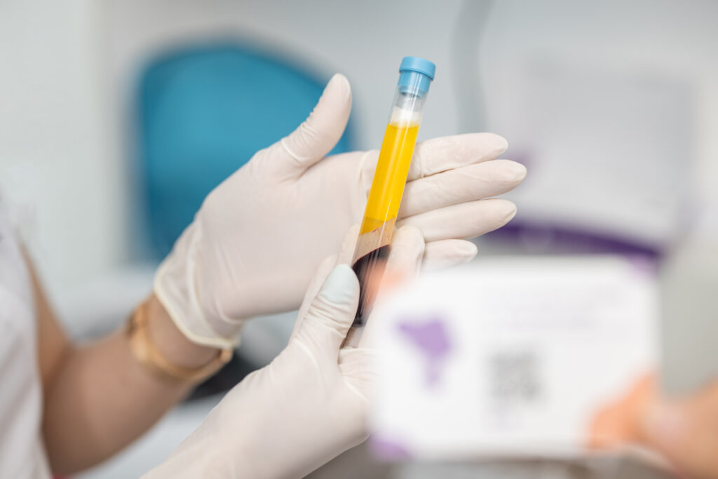 PRP Treatment Process and Principle - Sinymedical PRP Tube